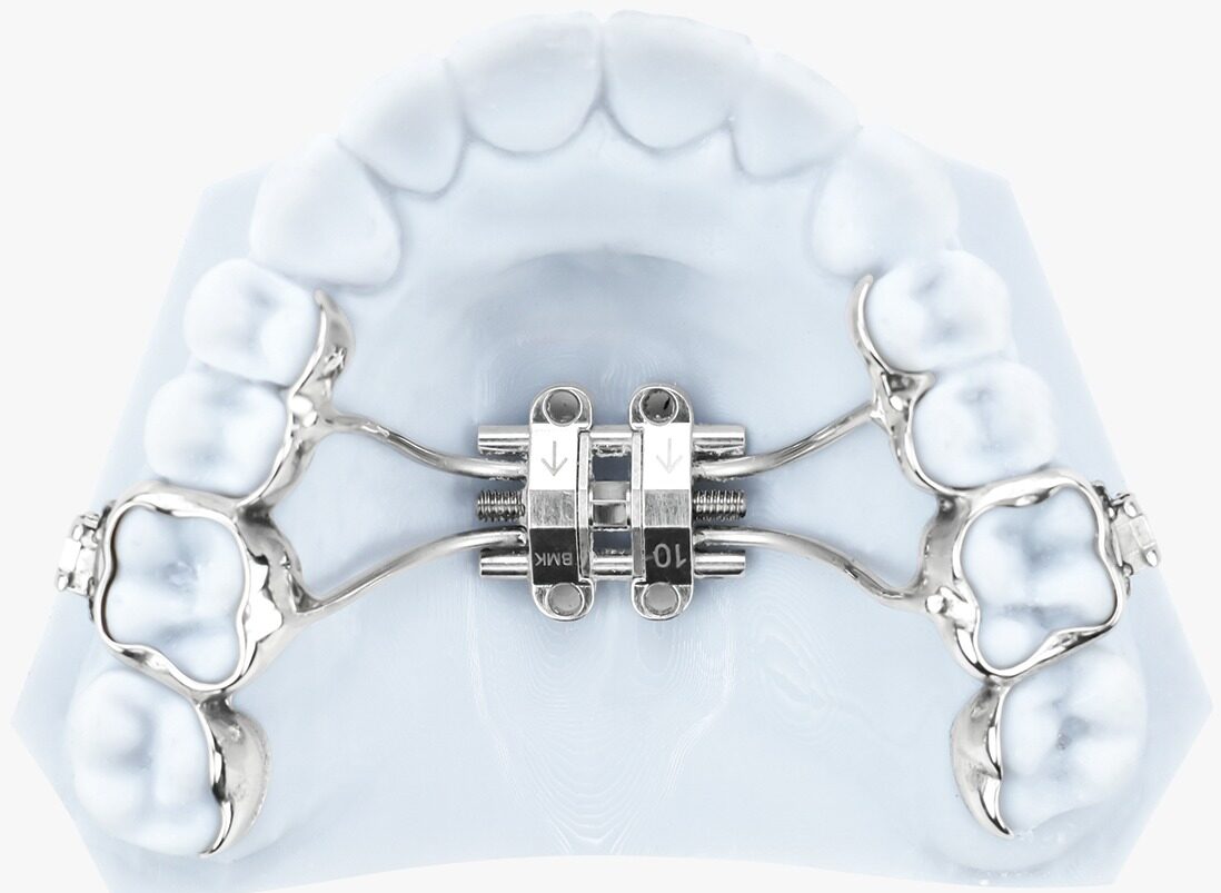 What Is MARPE in Orthodontics? Benefits & Uses | SMC Dubai